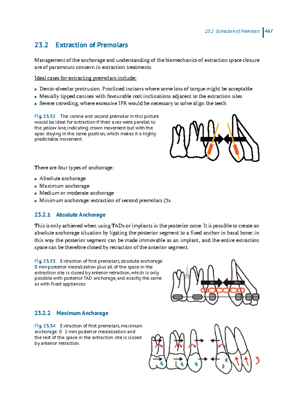 23.2 Premolar Extraction Techniques: Anchorage & Biomechanics in ...