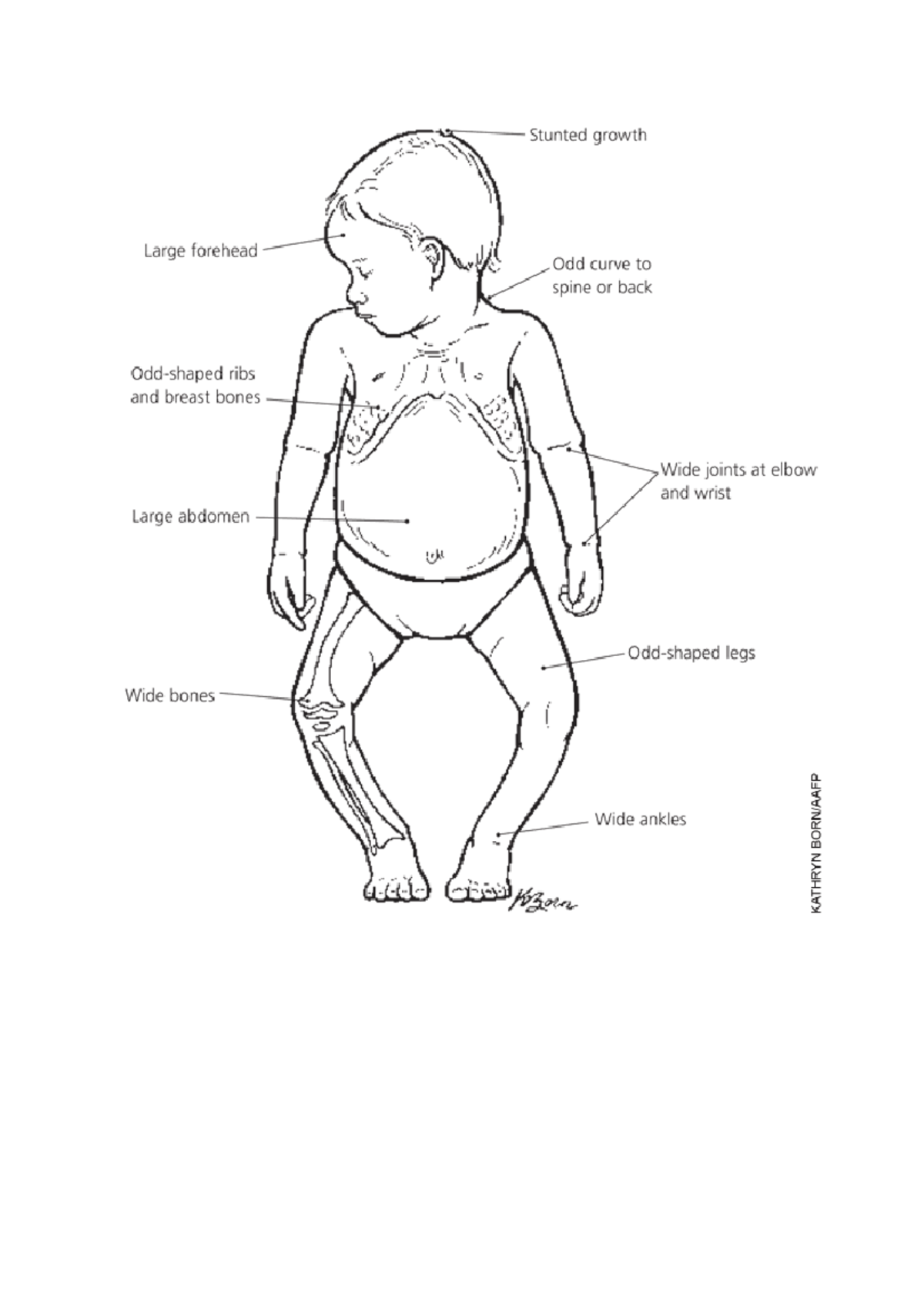 Science Rickets Disease - Stunted growth Large forehead Odd curve to ...