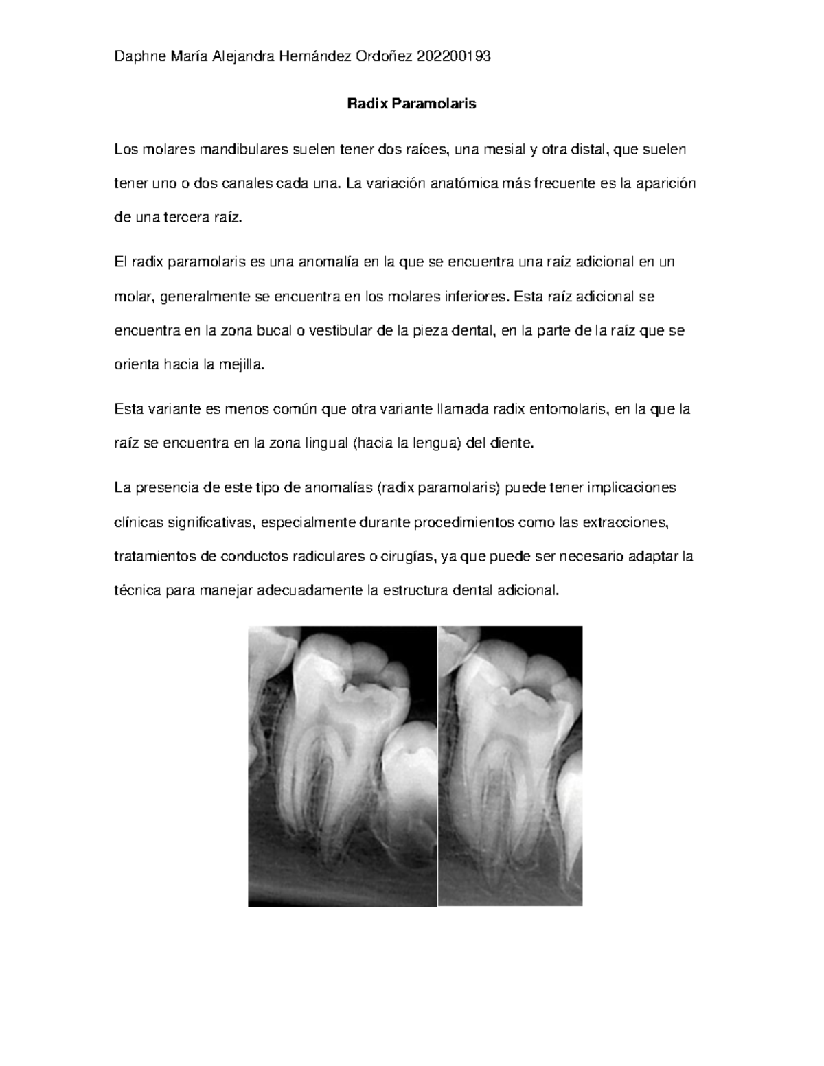 Radix Paramolaris en Molares Mandibulares: Análisis y Relevancia ...