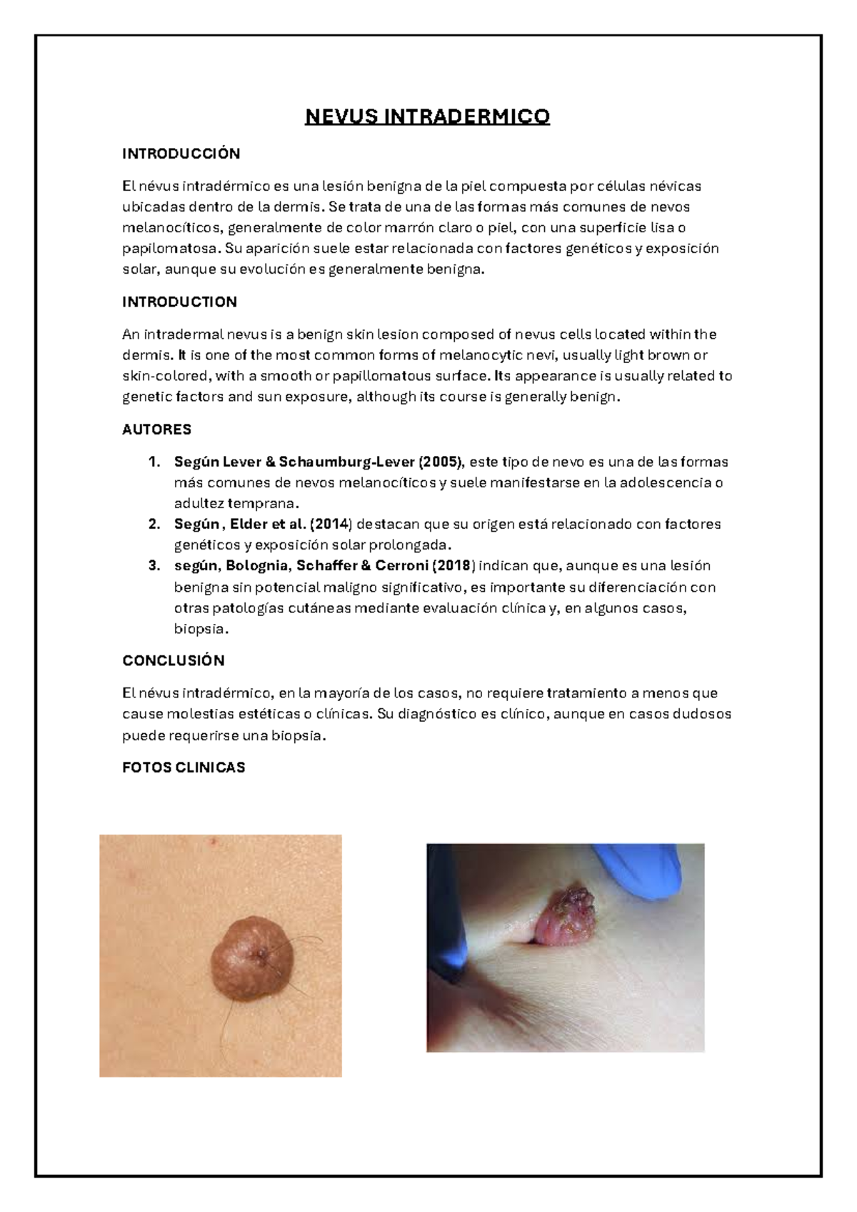 Nevus Intradérmico y Papiloma Escamoso: Estudio de Casos Clínicos - Studocu