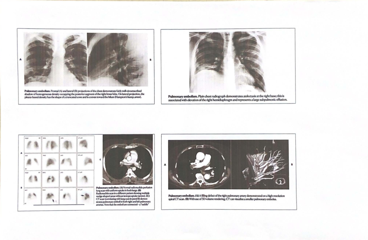 Radpatho-PART-2: Imaging of Pulmonary Embolism and Related Disorders ...