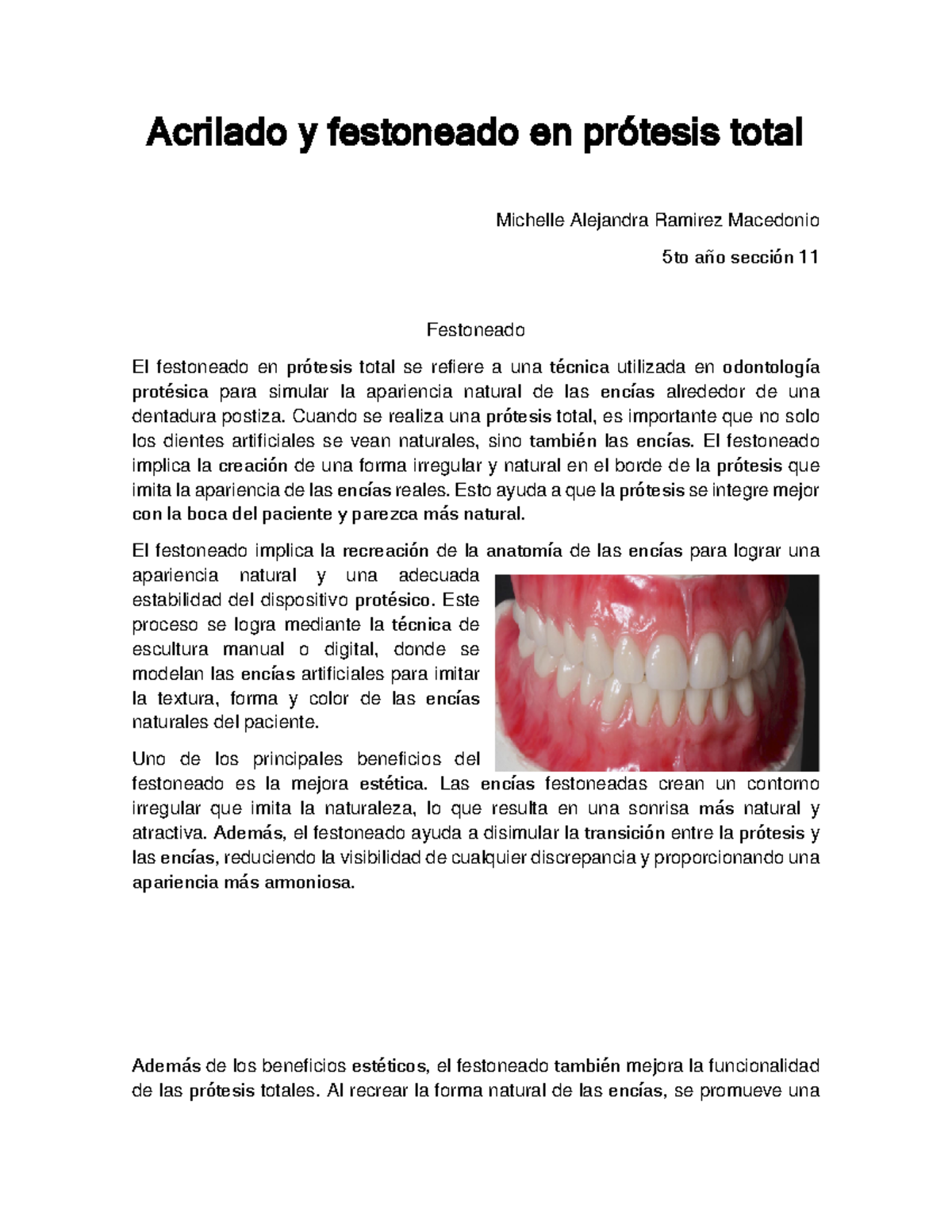 Técnicas de Acrilado y Festoneado en Prótesis Total: Proceso y ...
