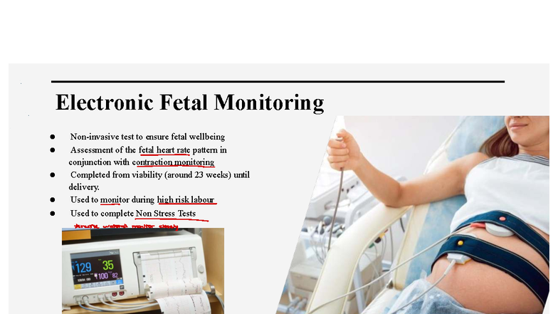 Electronic Fetal Monitoring (EFM) Overview and Assessment Techniques - Studocu