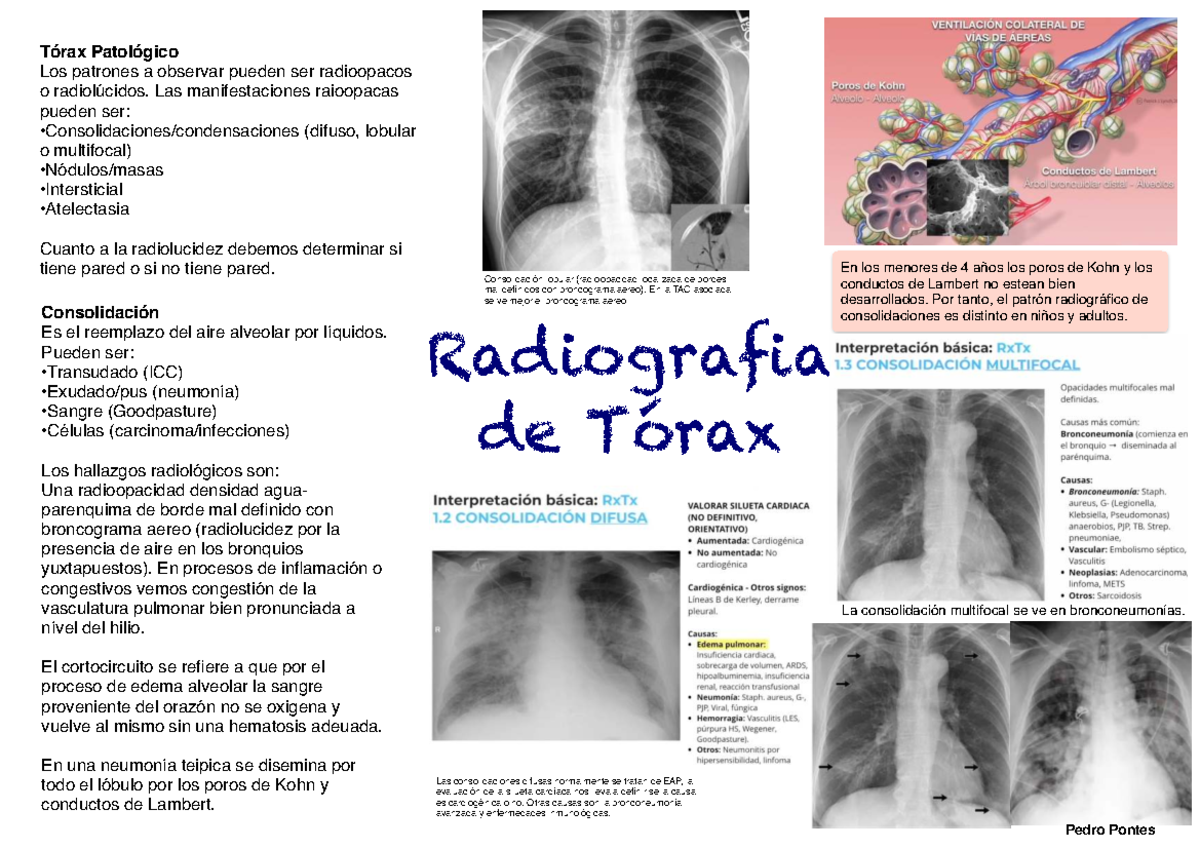 Radiografía de Tórax Patológico: Análisis y Hallazgos Clínicos - Studocu