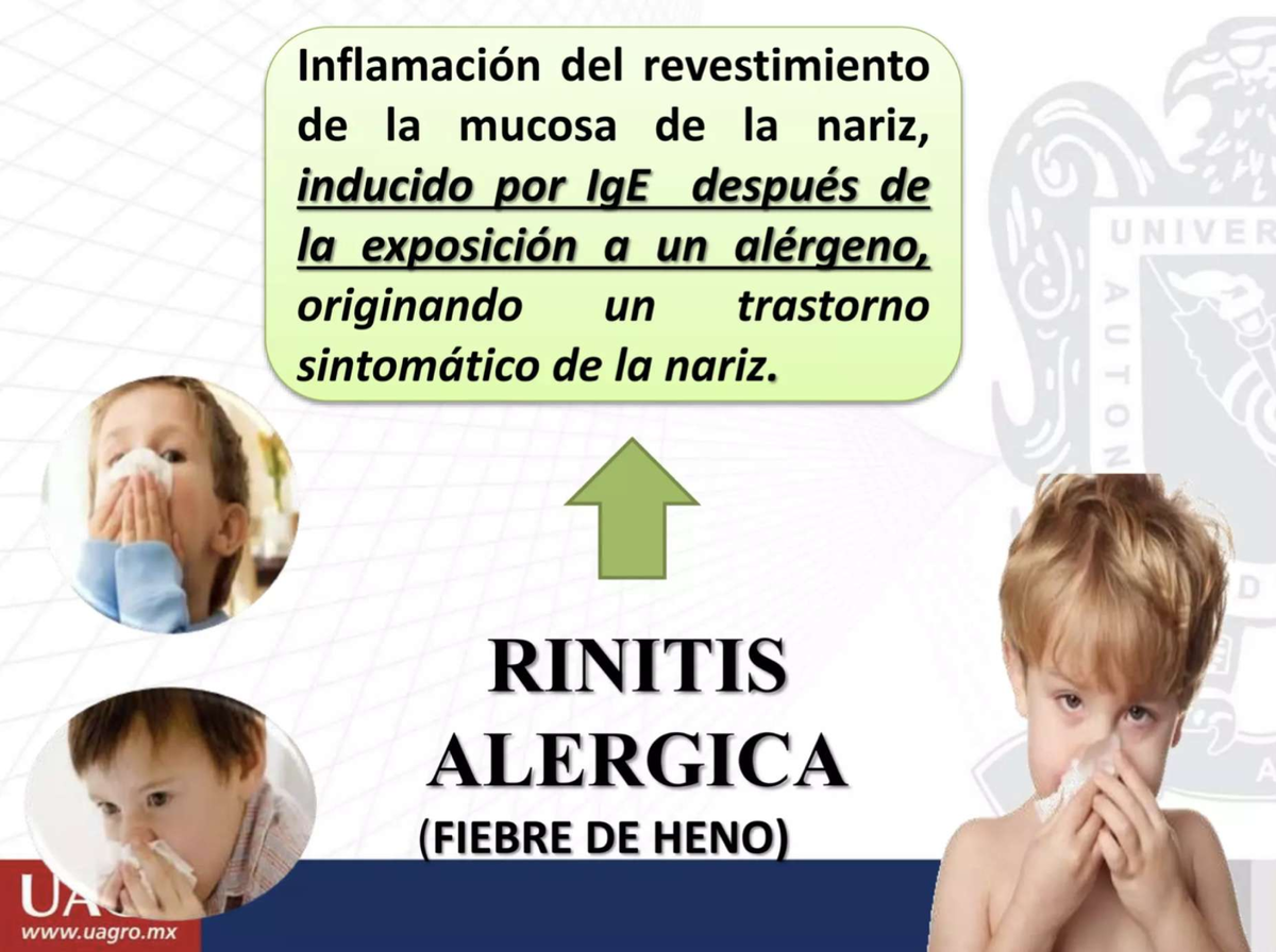 Rinitis Alérgica y Sinusitis: Fisiopatología y Diagnóstico UNIVE - Studocu