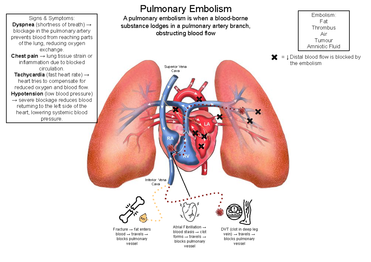 Pulmonary Embolism: Signs & Symptoms Overview - Studocu