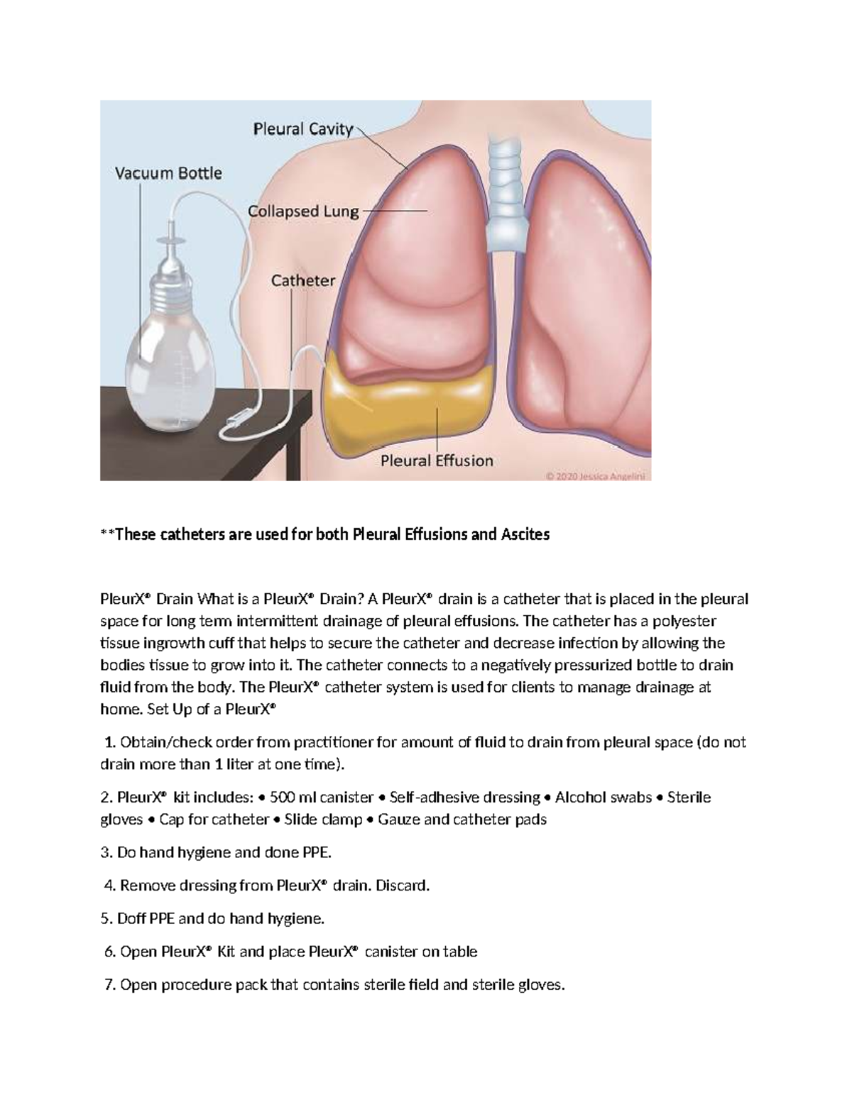 Pleurx Catheter Drainage: Managing Pleural Effusions & Ascites - Studocu