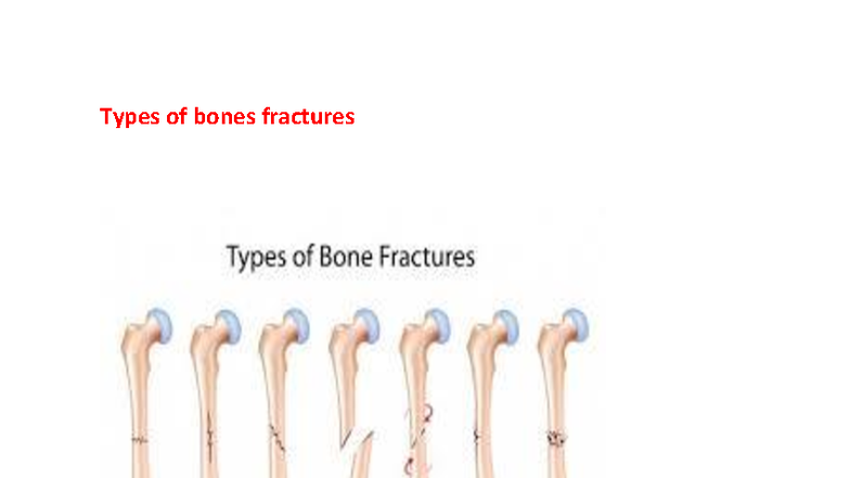 Types of Bone Fractures: Improve Your Health Through Reading - Studocu