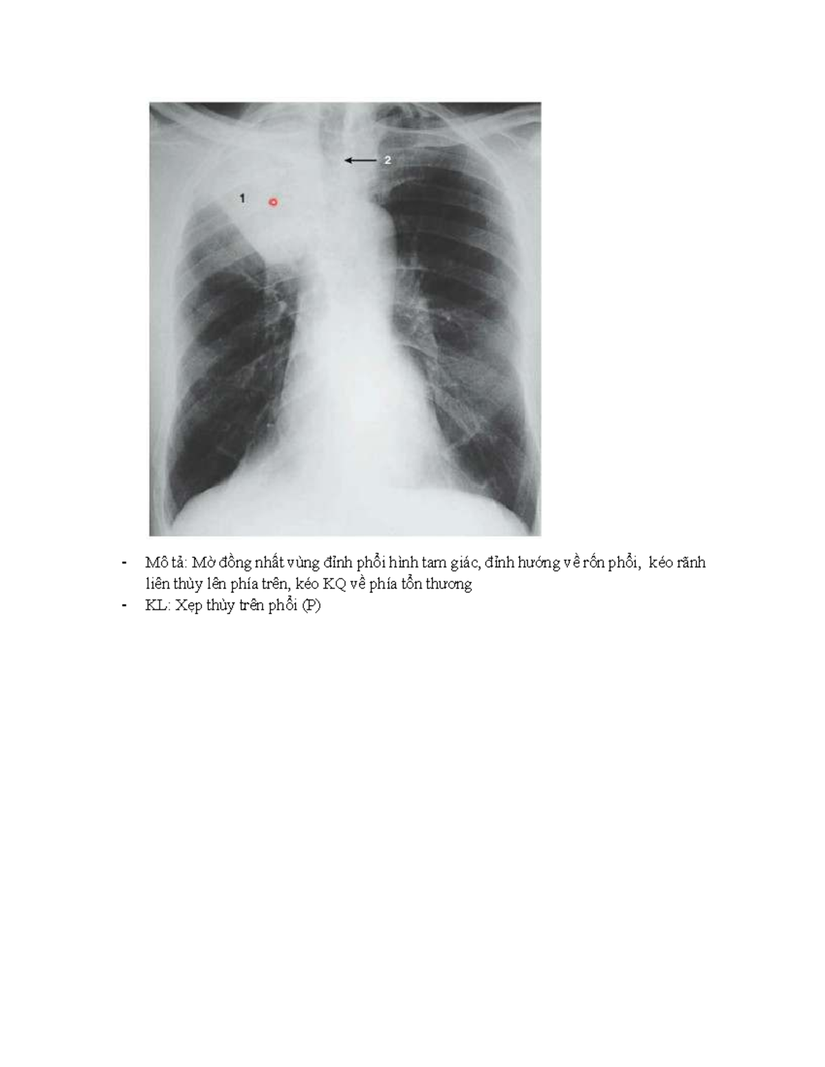LAO ÔN TẬP Xquang: Phân Tích Tổn Thương Phổi và Xẹp Phổi - Studocu