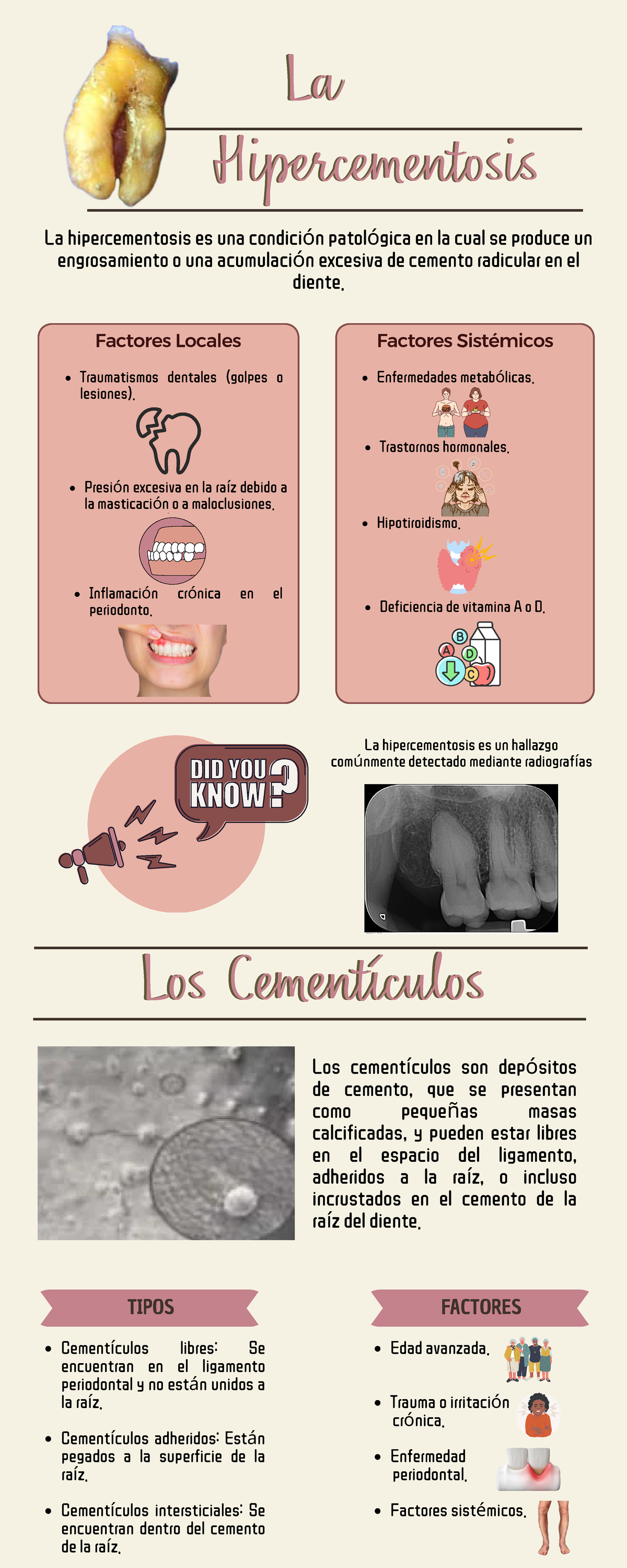 Hipercementosis y Cementículos: Factores y Prevención en Dentología ...