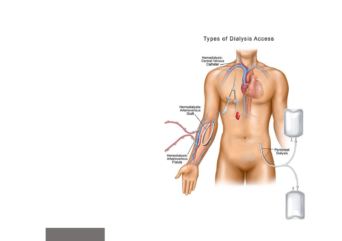 Dialysis Access Types Flow Chart - Peritoneal Dialysis Haemodialysis ...