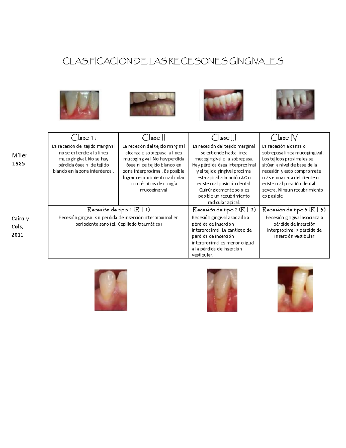 Clasificación de Recesiones Gingivales - Curso 101 - Studocu