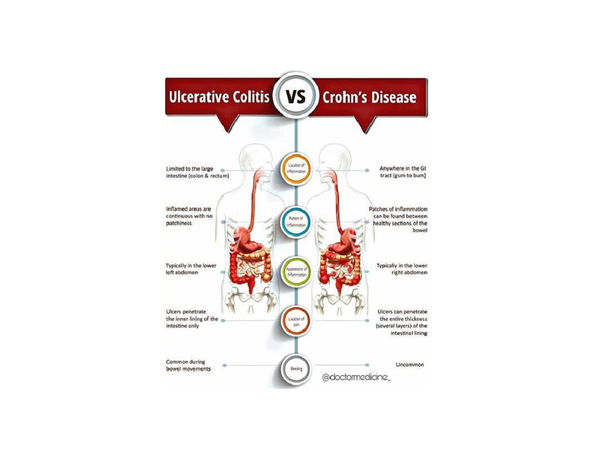 Crohn s vs ulcerative colitis 2 - Ulcerative Colitis VS Disease ...
