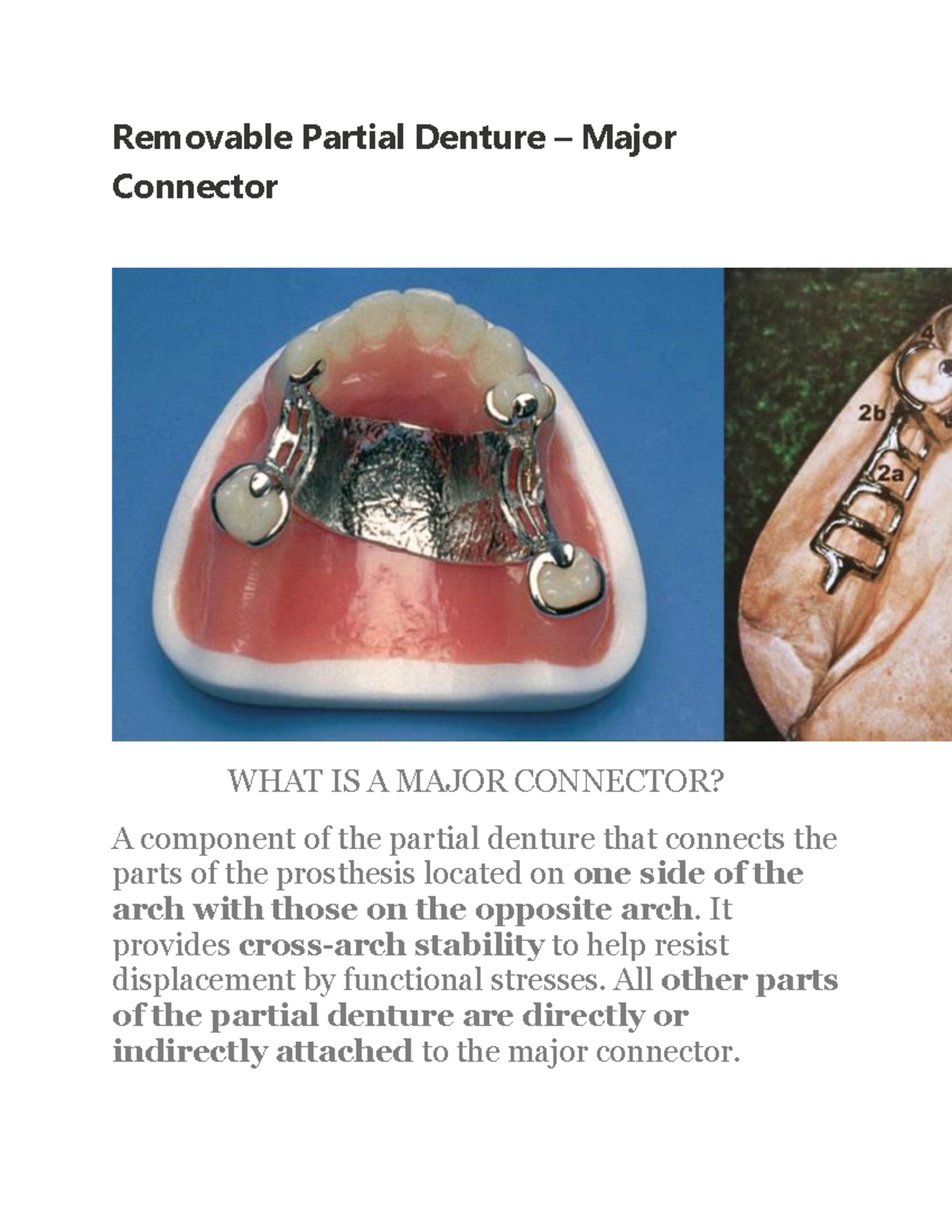 Removable Partial Denture – Major Connector - It provides cross-arch ...