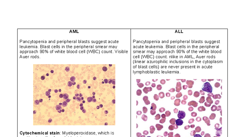 AML & ALL: Morphology of Leukemia with Peripheral Blasts - Studocu