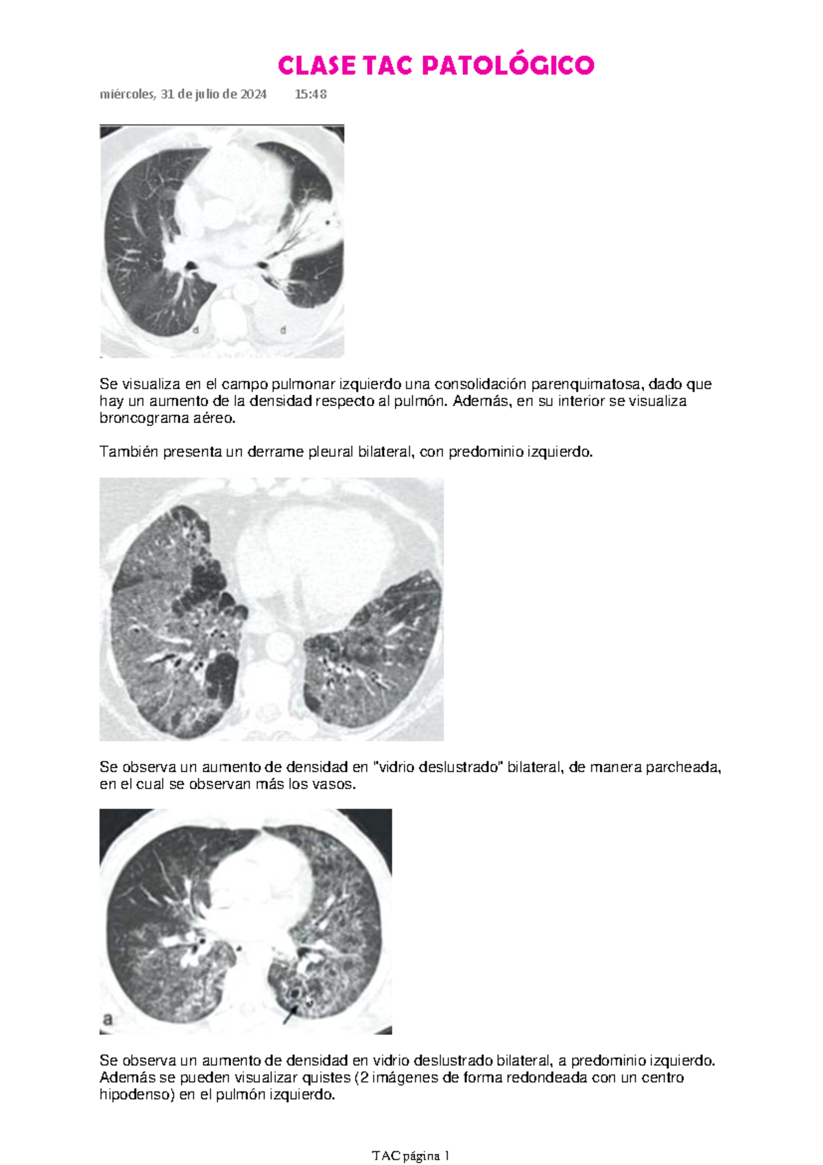 Clase TAC Patológico - TAC de tórax - Se visualiza en el campo pulmonar ...
