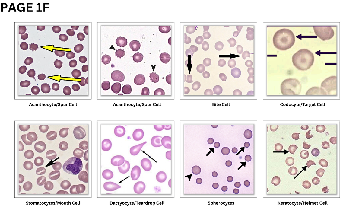 Poikilocytosis RBC Inclusions Study Flashcards - 2023 Edition - Studocu