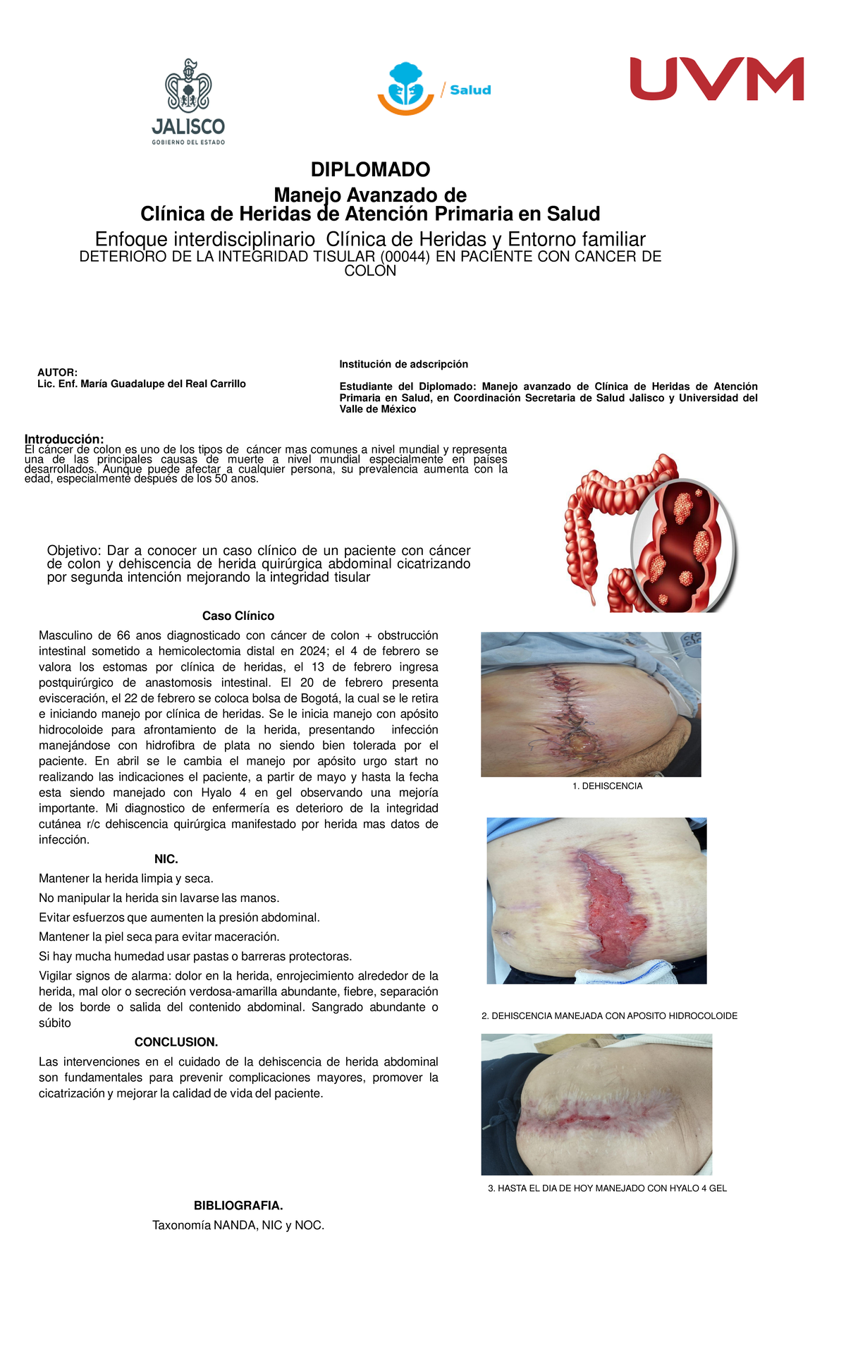 DIPLOMADO Manejo Avanzado de Clínica de Heridas: Caso de Cáncer de ...