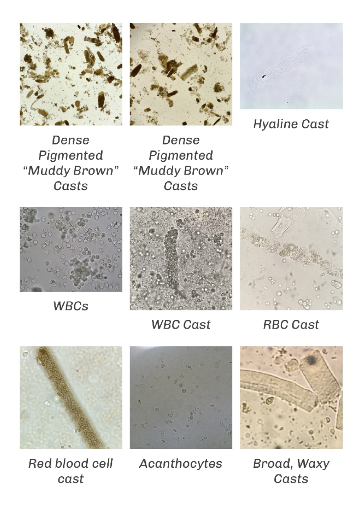 ANALYSIS OF URINE - Hyaline Cast Dense Dense Pigmented Pigmented Casts Casts WBCs WBC Cast RBC ...