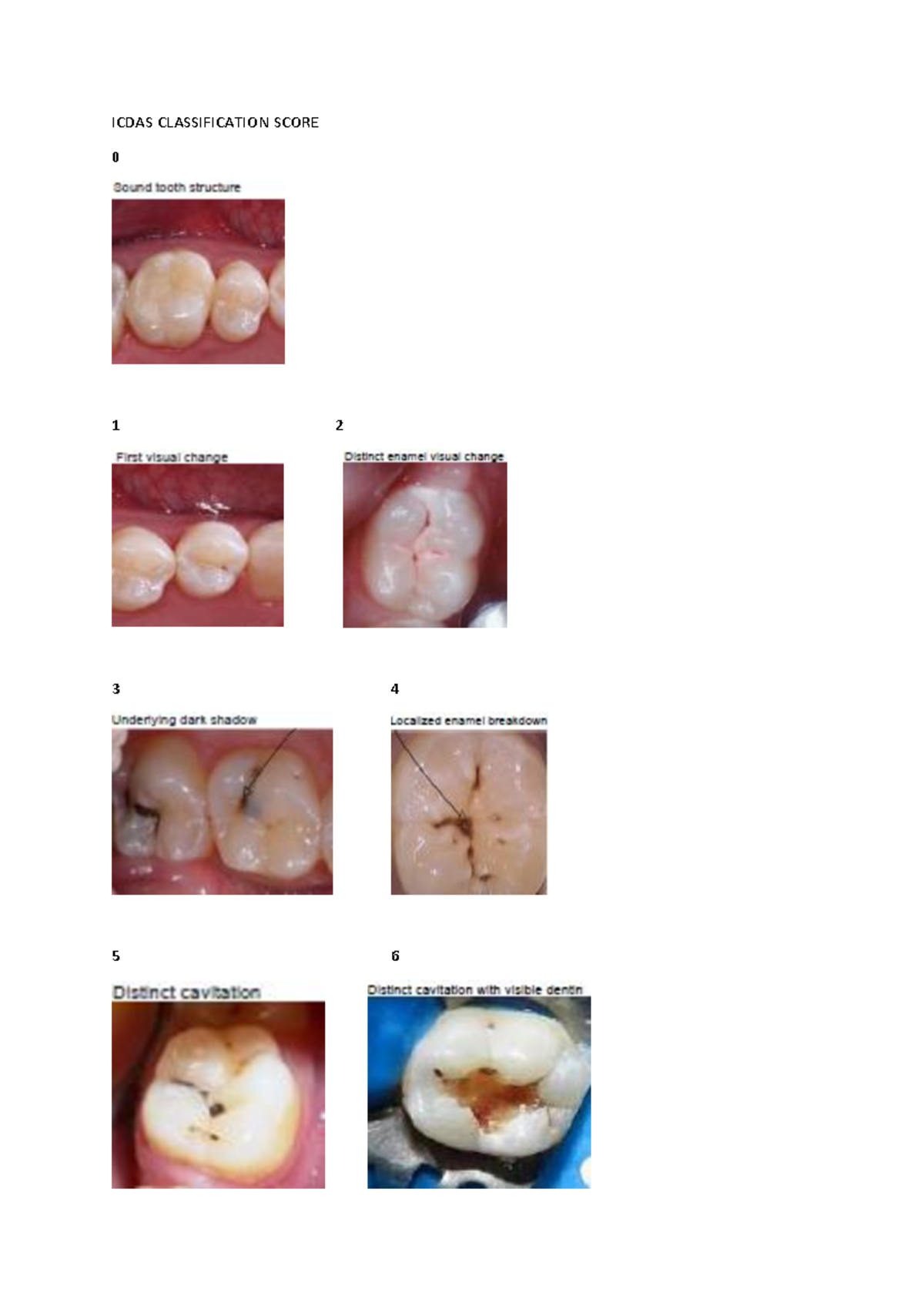 Lecture%206%20 Caries%20 Icdas%20 Classification%20 Score - GTS 351 ...