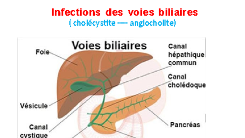 Infections des voies biliaires : Cholécystite et Angiocholite - Studocu