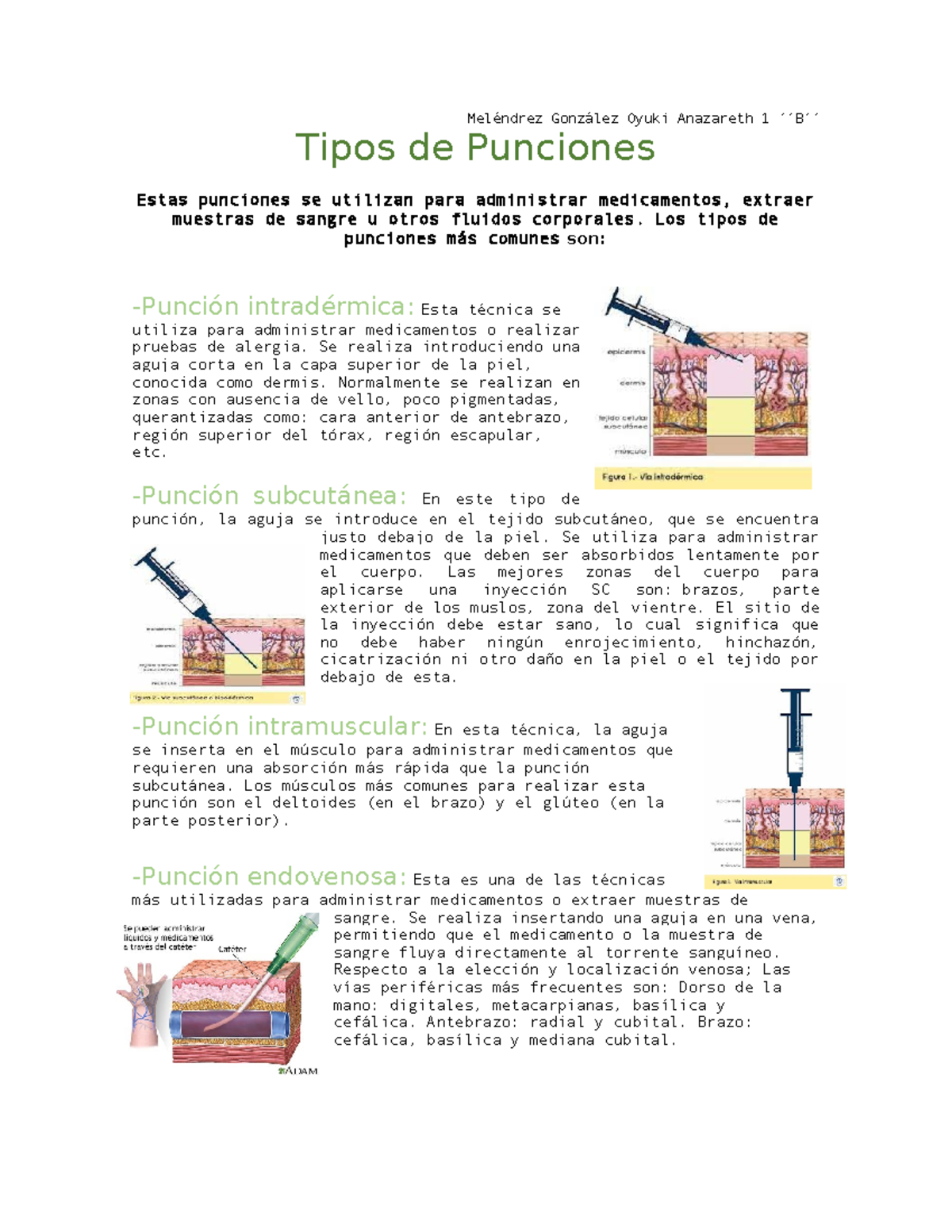 Tipos de Punciones: Intradérmica, Subcutánea, Intramuscular y ...