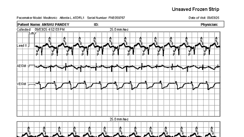 Pacemaker Data Report: Medtronic Attesta L ATDRL1 for Anshu Pandey ...