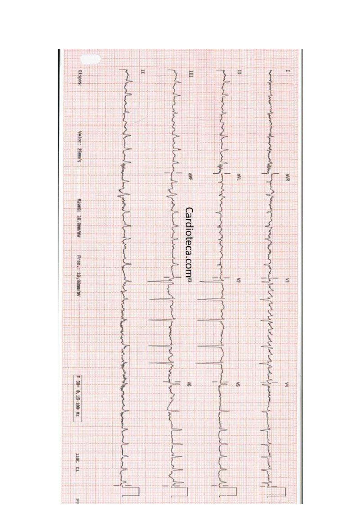 Documento sin título - Imagen de electro - Fisiología - I aVR V1 V4 II ...
